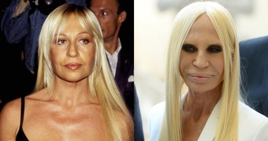 IMAGES: 10 celebrities deformed by plastic surgery - Famagusta News