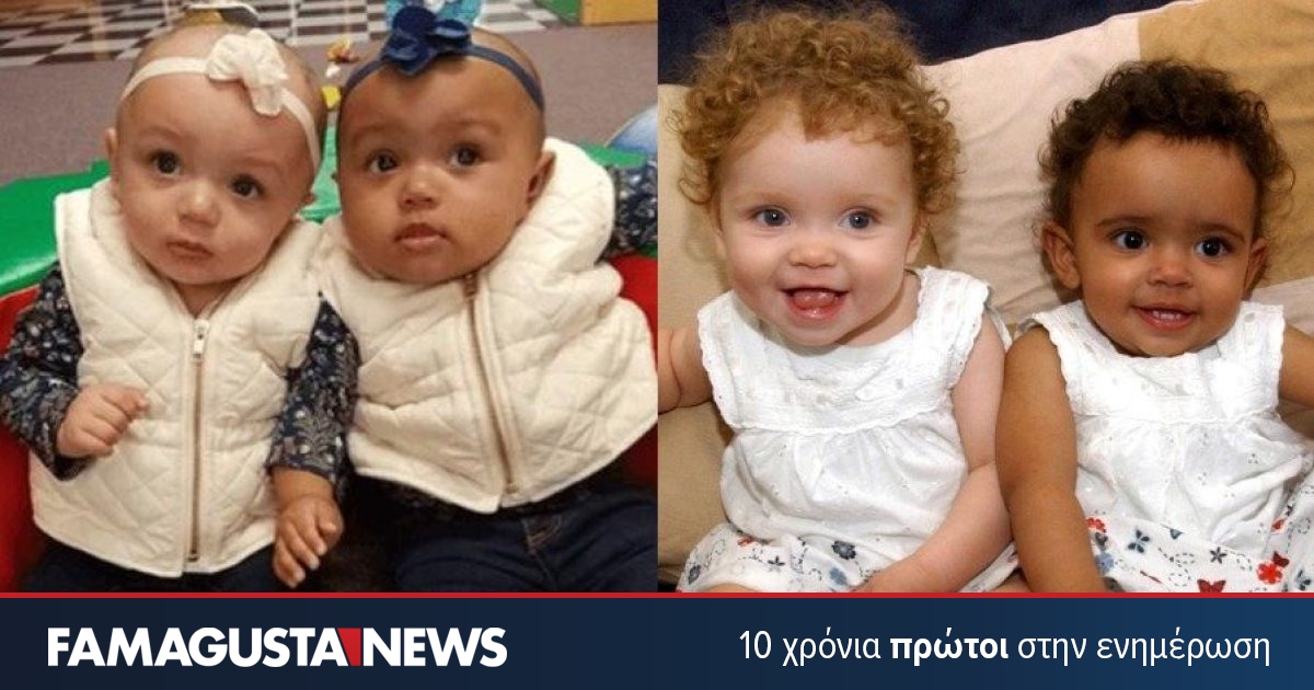 IMAGES: Twin girls were born with a different color and 22 years later ...